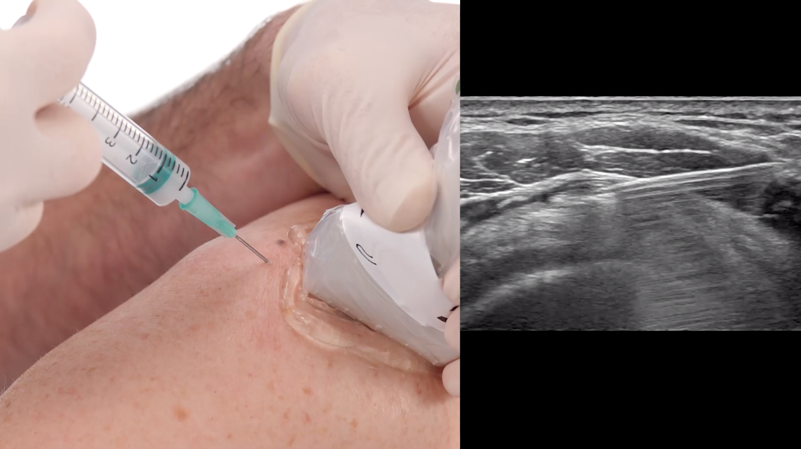 Meralgia Paresthetica Injection Site Images And Photos Finder